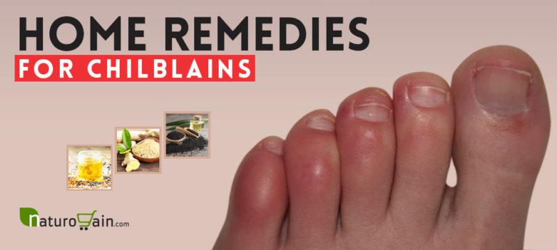 10 Best Home Remedies for Chilblains that Work Fast [Naturally]