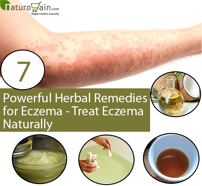 7 Powerful Herbal Remedies For Eczema Treat Eczema Naturally
