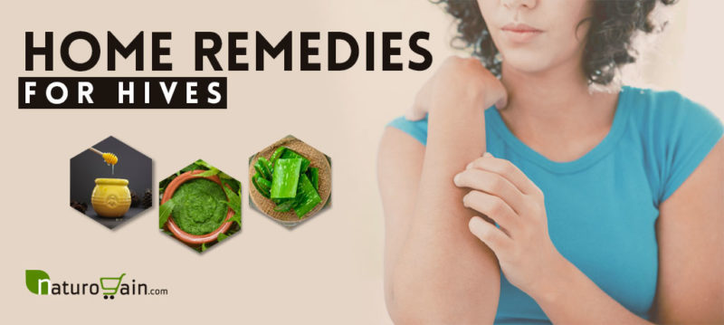 8 Best Home Remedies For Hives To Relieve Itching [naturally]