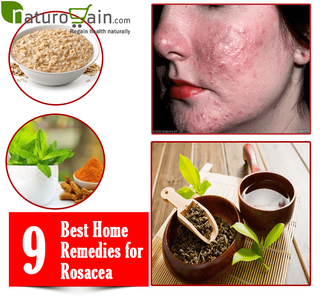 9 Best Home Remedies For Rosacea That Give Fast Relief