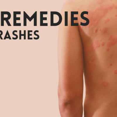 7 Best Home Remedies for Scabies to Prevent Skin Rashes