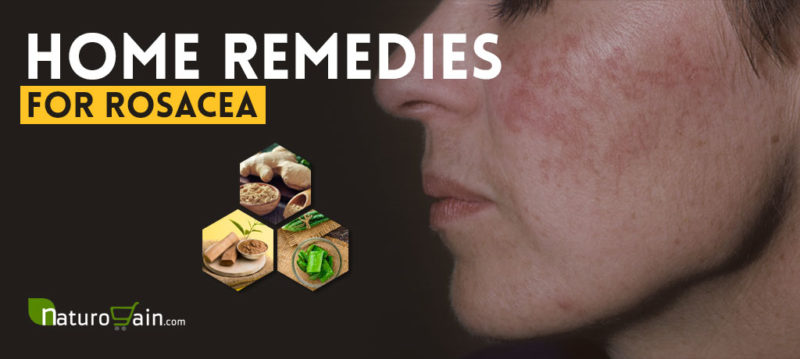 6 DIY Home Remedies for Rosacea - Natural Skin Care Tips