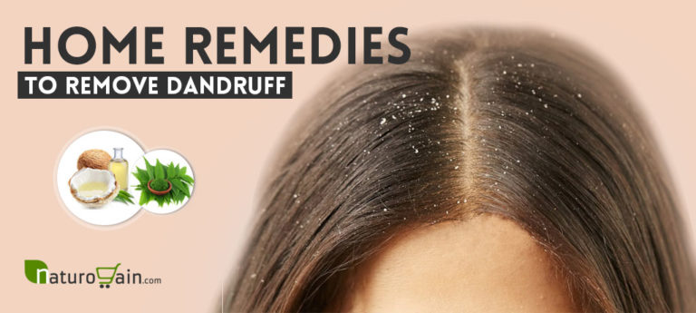 10 Best Home Remedies to Remove Dandruff Fast (Naturally)