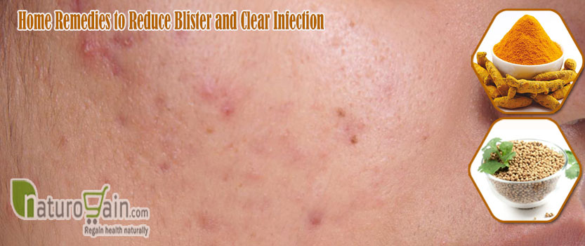 10 Best Home Remedies for Zits to Get Rid of Pimples