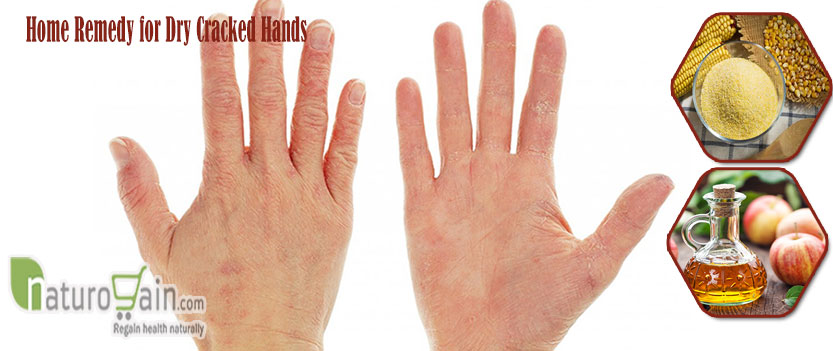 8 Home Remedies For Dry Cracked Hands 100 Pure Natural Treatment