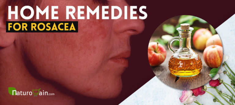 10 Powerful Herbal Remedies for Rosacea - Treat Symptoms [Naturally]