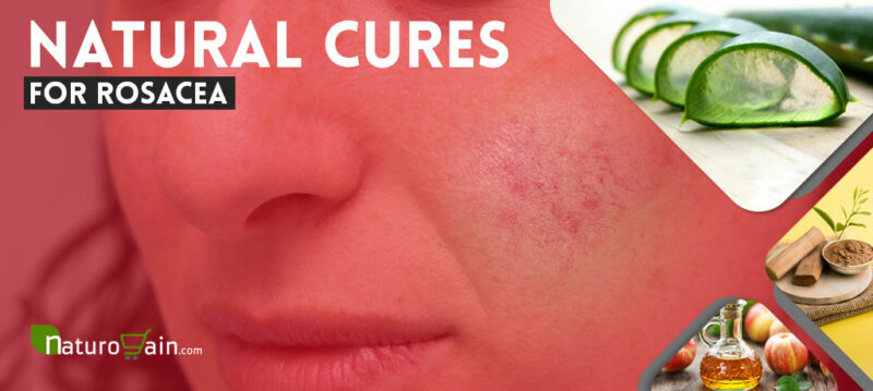 12 Natural Cures for Rosacea - Treat Symptoms Naturally at Home [Tips]