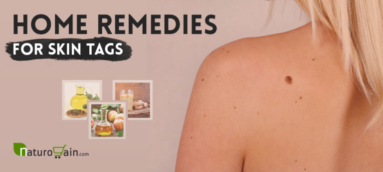 13 Simple and Best Home Remedies for Skin Tags that Work [Naturally]