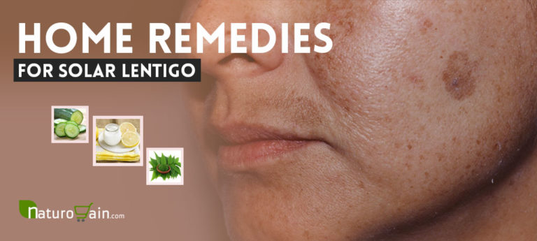 9 Best Home Remedies for Solar Lentigo to Improve Skin Health