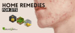 10 Best Home Remedies for Zits to Get Rid of Pimples [Naturally]